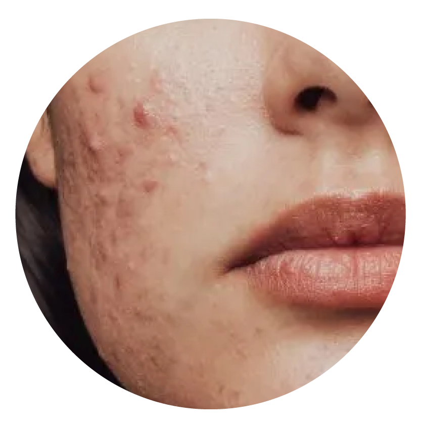 Acne – Viah Beauty
